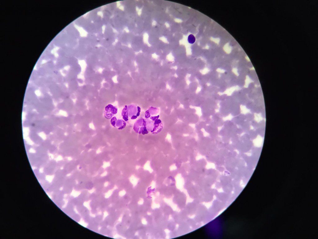 [Bệnh học] SUY NGẪM VỀ LE CELL VÀ BỆNH TỰ MIỄN! › Y khoa