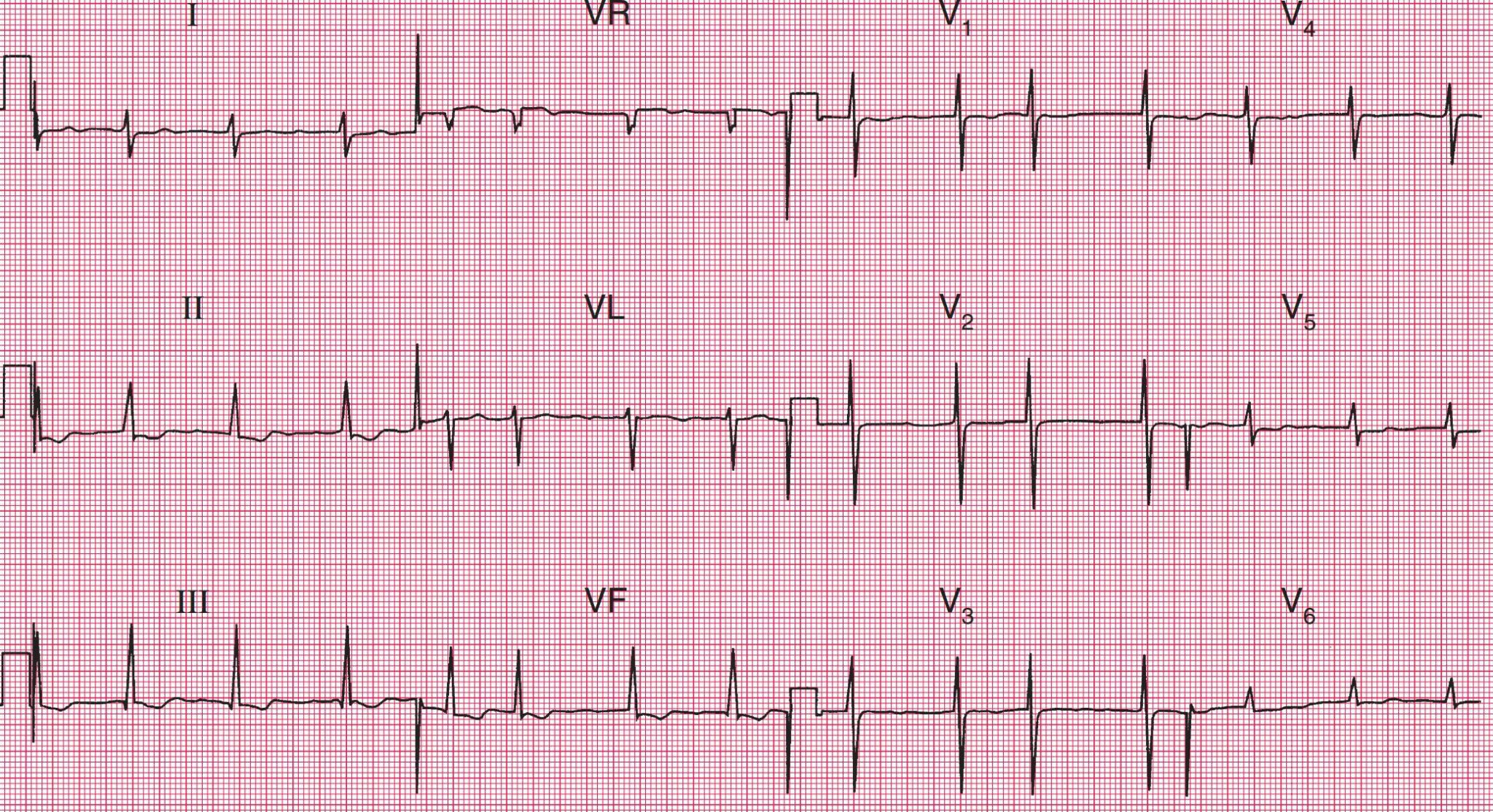 [ECG] Một số điện tâm đồ lớn nhĩ và phì đại thất › Y khoa