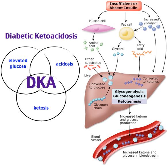 Sinh L Th V S 35 Toan Chuy n H a Ketoacidosis Ti u ng DKA sinh-l-th-v-s-35-toan-chuy-n-h-a-ketoacidosis-ti-u-ng-dka