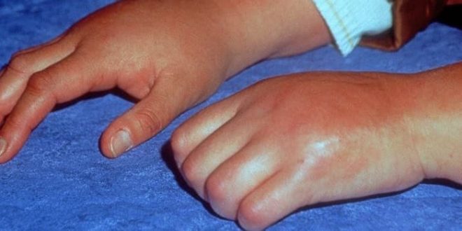 [Bệnh học] Hội chứng Sudeck › Y khoa