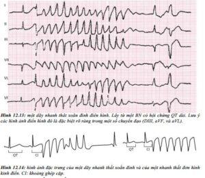 [ECG SỐ 12] Các dạng ECG của loạn nhịp thất › Y khoa