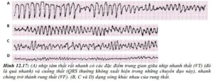 [ECG SỐ 12] Các dạng ECG của loạn nhịp thất › Y khoa