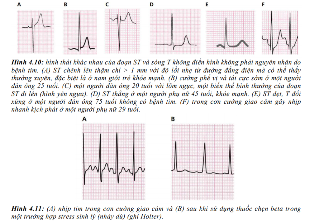 [ECG Số 4] Phân tích chi tiết về ECG › Y khoa