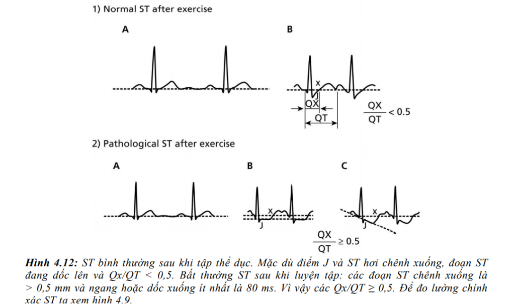 [ECG Số 4] Phân tích chi tiết về ECG › Y khoa
