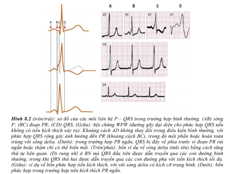 [ECG Số 8] Hội chứng kích thích sớm › Y khoa