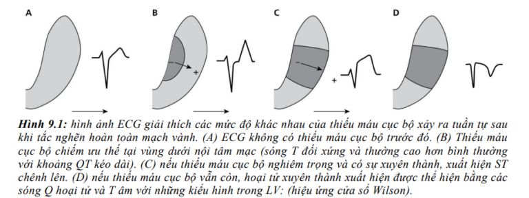 [ECG Số 9] Nhồi máu và thiếu máu cục bộ cơ tim › Y khoa