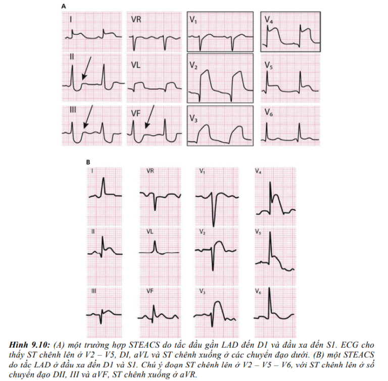 [ECG Số 9] Nhồi máu và thiếu máu cục bộ cơ tim › Y khoa
