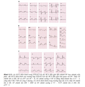 [ECG Số 9] Nhồi máu và thiếu máu cục bộ cơ tim › Y khoa