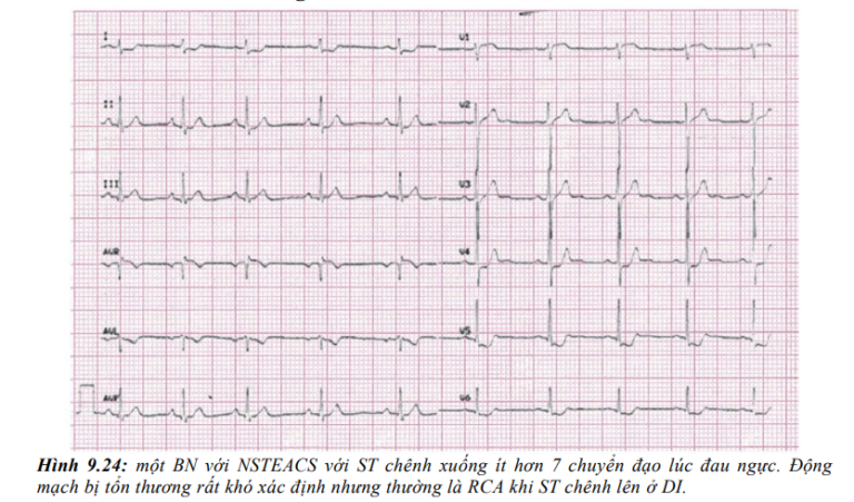 [ECG Số 9] Nhồi máu và thiếu máu cục bộ cơ tim › Y khoa