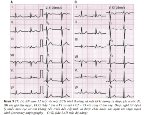 [ECG Số 9] Nhồi máu và thiếu máu cục bộ cơ tim › Y khoa
