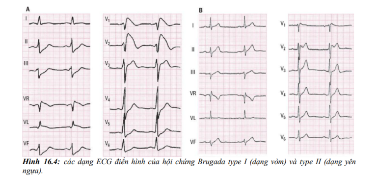[ECG Số16] ECG trong bệnh lý tim mạch do di truyền và các dạng ECG với ...