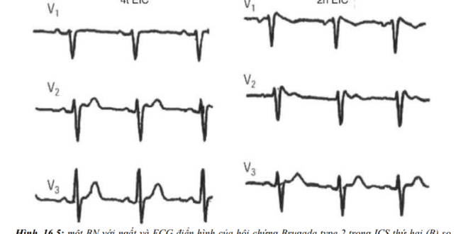 [ECG Số16] ECG trong bệnh lý tim mạch do di truyền và các dạng ECG với ...