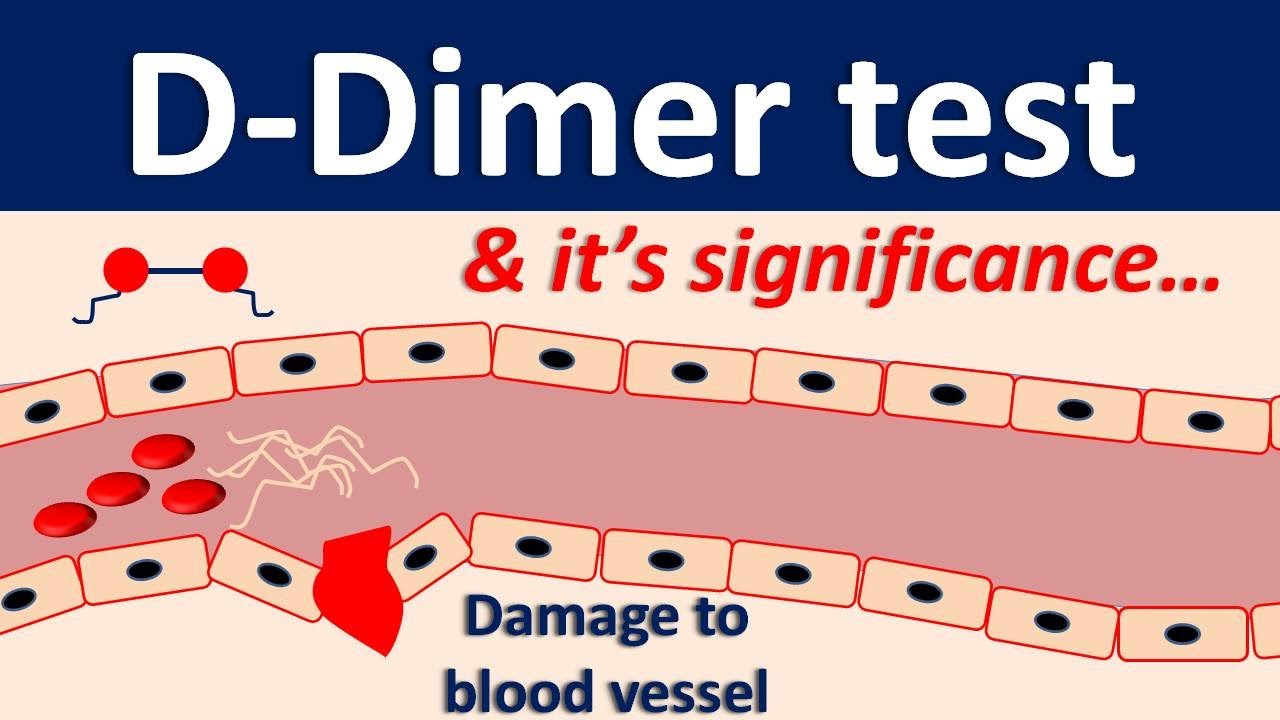 [Xét nghiệm 27] D-Dimer (D-dimères / D-dimer, D-dimer Test) › Y khoa