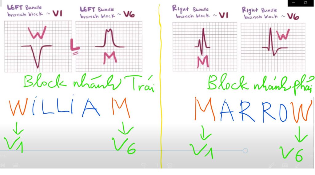 [Tim mạch] GHI NHỚ ĐIỆN TÂM ĐỒ (ECG) BLOCK NHÁNH CHỈ BẰNG MỘT HÌNH ẢNH ...