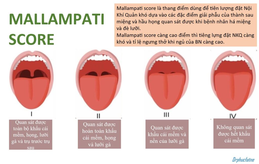 [Mỗi Ngày Một Tham Khảo 21] Thang điểm Mallampati – Y khoa