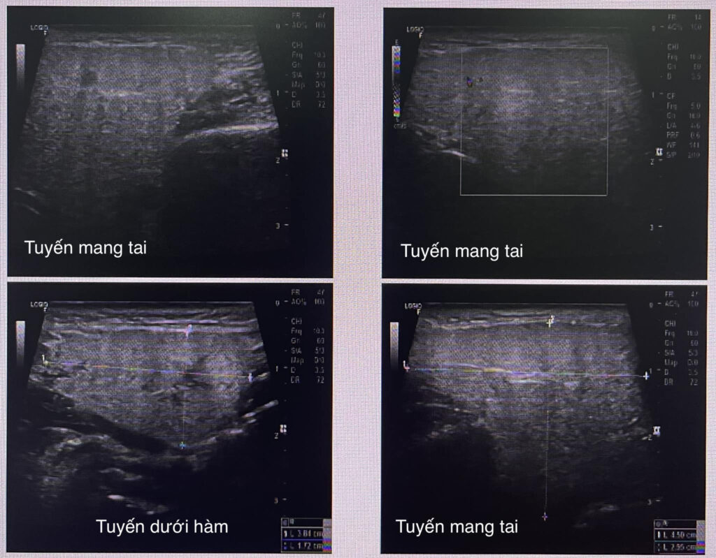 Chứng ứa nước bọt (Sialosis, sialadenosis) › Y khoa