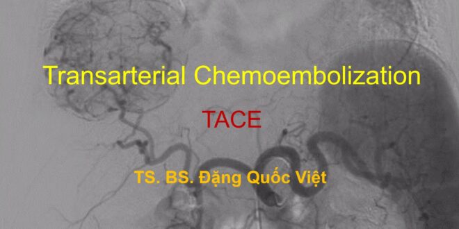 TACE là gì? › Y khoa