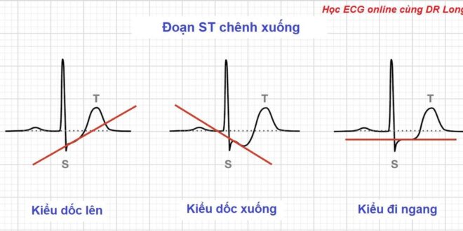 SỰ THAY ĐỔI ĐOẠN ST TRÊN ECG › Y khoa