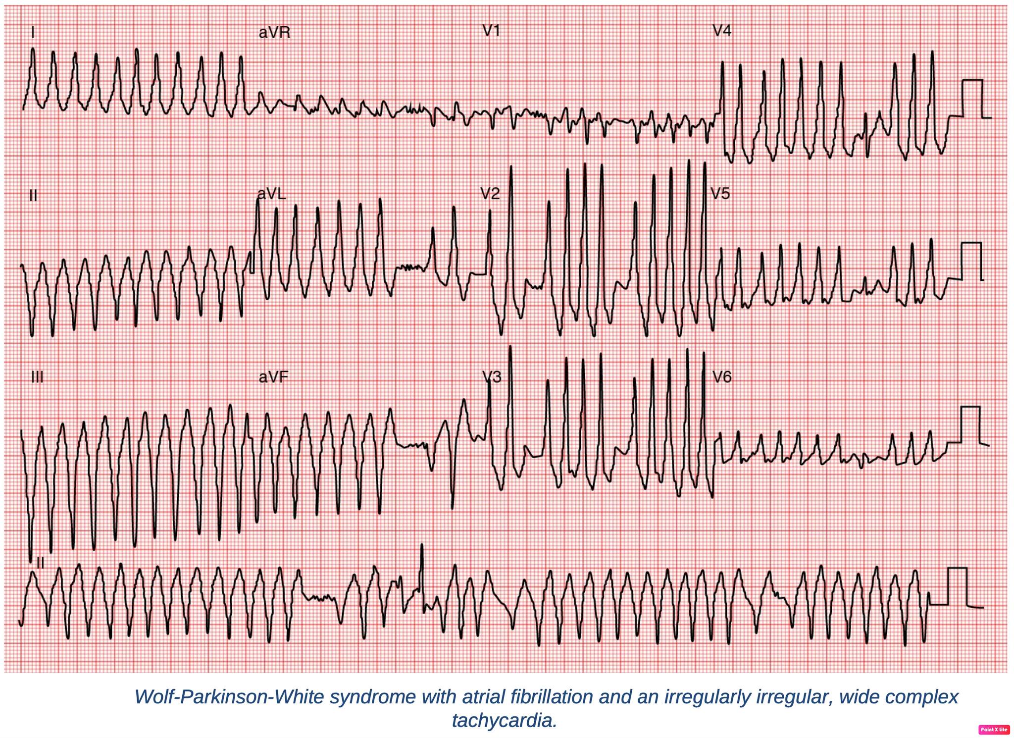 Rung nhĩ kèm Hội chứng Wolff - Parkinson - White (WPW) › Y khoa