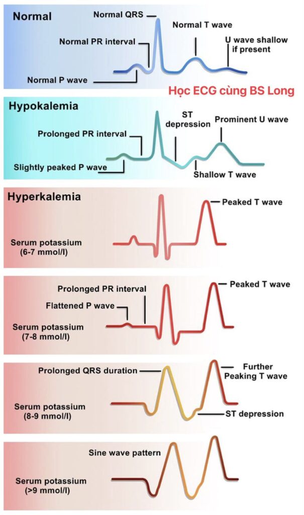 ĐIỆN TÂM ĐỒ TĂNG KALI MÁU HẠ KALI MÁU › Y khoa